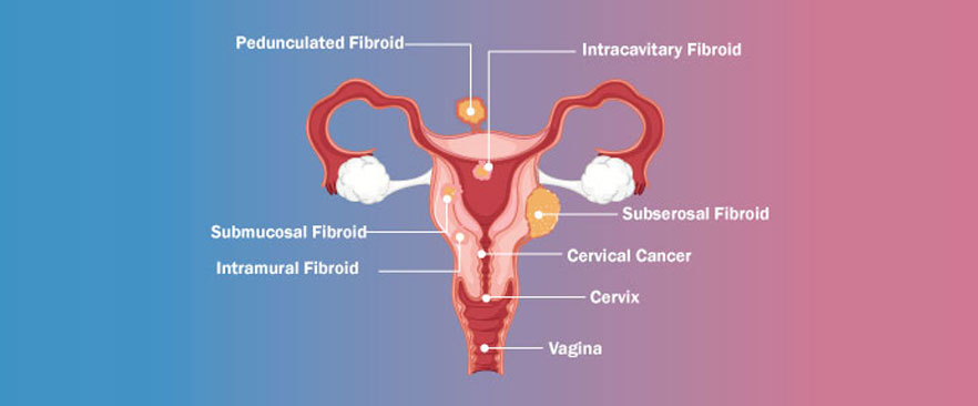 Gynecological Cancers